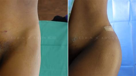 Hip Implants Edwin Kwon Md Facs