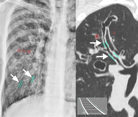 Bronchiectasis X Ray Tram Track Bronchiectasis And Role Of Surgical