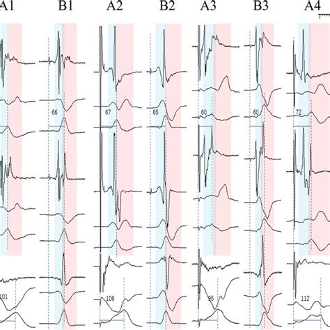 Iegm And Ecg In The Pacing And Sense Only Mode At The Final Test Where