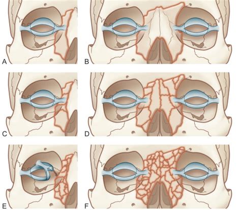 Noe Fracture Types