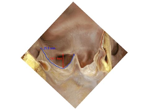 Aortic Leaflets Aortic Leaflets