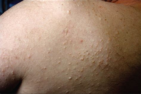 Papular Mucinosis