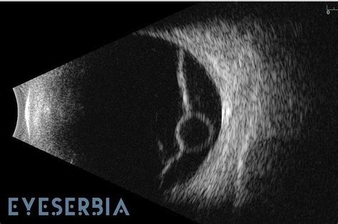 Retinal Cyst In Chronic Ophthalmology Notes And Synopses