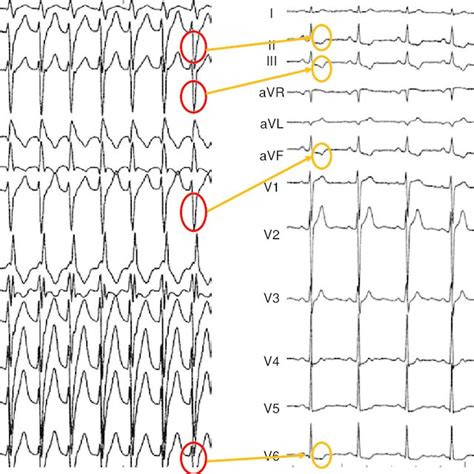 An Example Of Memory Induced T Waves Observed After Radiofrequency Download Scientific