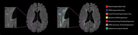 Penn Dbei Automatic Threshold Detection For Classification Of Lesions