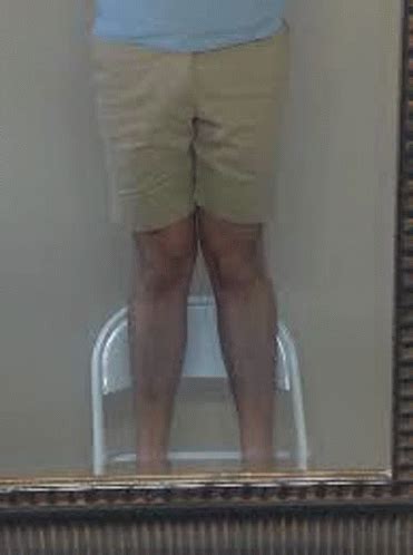 Knock Knees  Knock Knees Discover And Share S