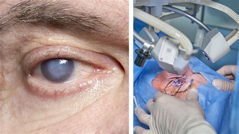 Cataract Surgery