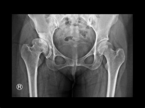 Hip Dysplasia Signs Symptoms Treatment Los Angeles Ca Hip Surgeon