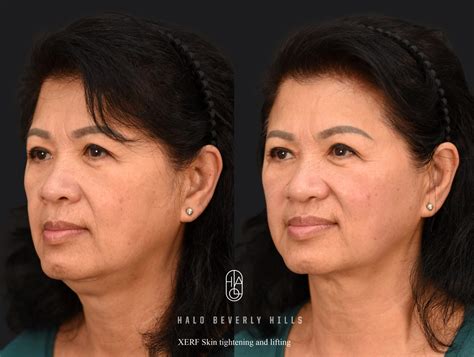 Xerf Radiofrequency Skin Tightening A Non Surgical Option For Facial