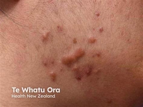 Keloid Scalp Keloids Keloid Removal Expert New York