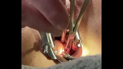 Holding Cervix W Tenaculum While 8mm Dilator Fucks Uterus Xxx Mobile Porno Videos And Movies