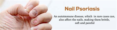 Nail Psoriasis Causes Symptoms Diagnosis Treatment And Prevention