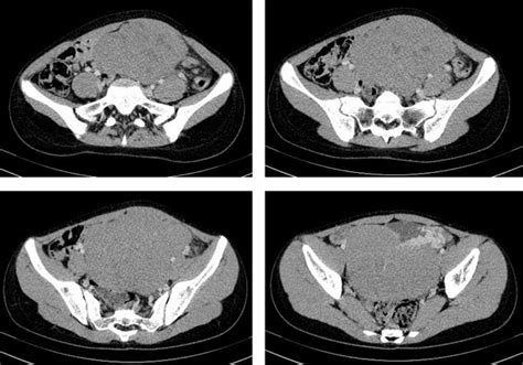 2 Компьютерно томографическая семиотика заболеваний половой системы