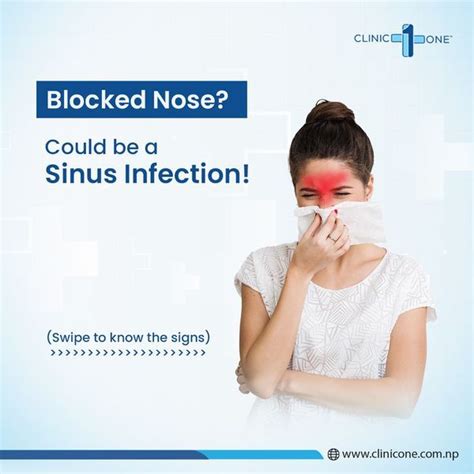 Sinusitis Also Known As A Sinus Infection Occurs When The Tissue