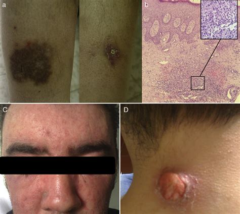 A Lesions Evolved To Ulcers And Cribriform Scars B Dense