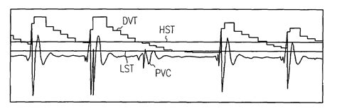 Apparatus And Method For R Wave Detection With Dual Dynamic Sensitivities Eureka Patsnap