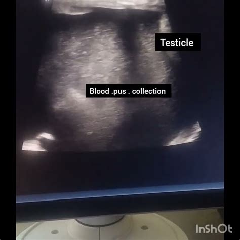 Scrotal Scan Hemeocele Pyocele Youtube