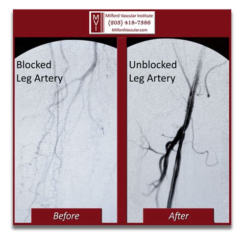 Pad Treatment In New Haven County For Peripheral Artery Disease