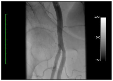 Image Diagnosis Rapidly Enlarging Scrotal Hematoma A Complication Of