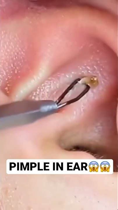 Blackhead Pimple In Ear Popped Pimple Blackhead Youtube