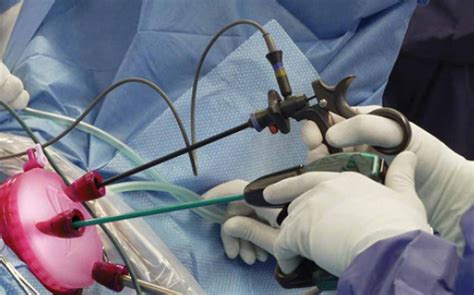 Vnotes The Newest Non Invasive Hysterectomy Procedure Azgyn