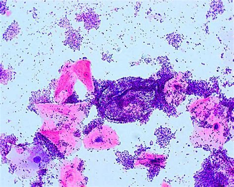 [gram Stain] Clue Cell From A High Vaginal Swab Hvs Sample Scrolller