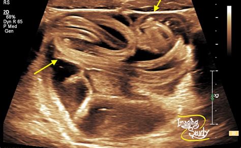 Case 56 Intestinal Ascariasis Ultrasound ~ Imaging Study