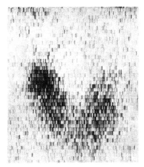 Rectilinear Thyroid Scan Demonstrates Hyperfunctioning Nodule In Upper