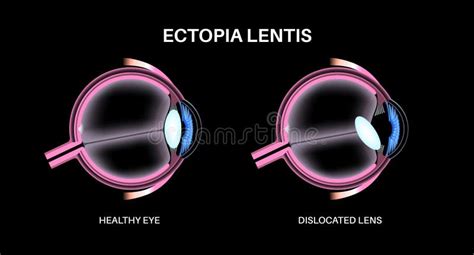 Ectopia Lentis Disease Stock Vector Illustration Of Ophthalmology
