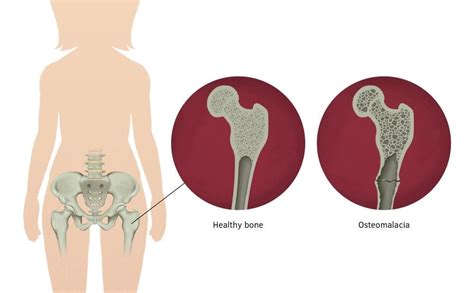 Osteomalacia Bone