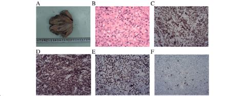 Pathologic Gross A And Microscopic Features Of Thespecimen B Download Scientific Diagram