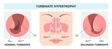 Turbinate Surgery Recovery