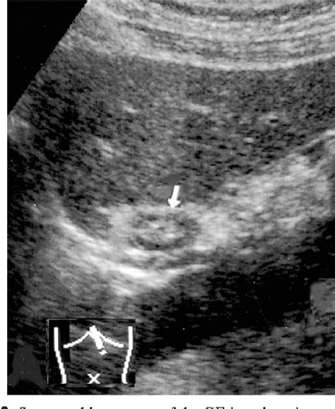 Gastroesophageal Junction Ultrasound