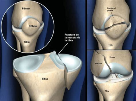 Síntomas De Fractura De Tibia