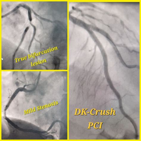 Michael Gergis On Linkedin Pci Bifurcation
