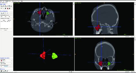 segmentation procedure of ma­ xillary sinus using itk­snap download