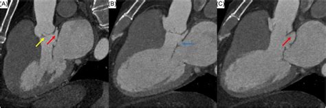 Ccta Revealed A Small Aortic Valve Vegetation A Yellow Arrow