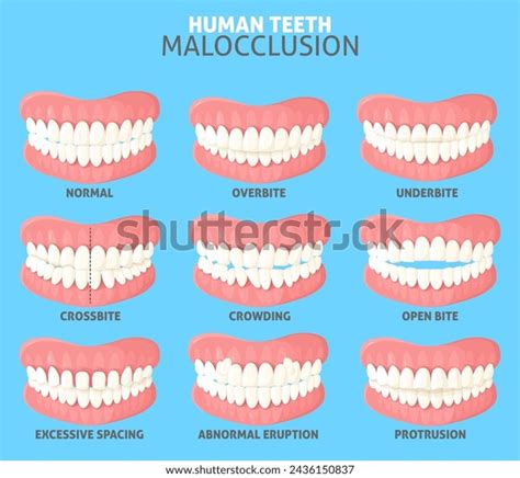 Different Human Teeth Malocclusion Types Set เวกเตอร์สต็อก ปลอดค่า