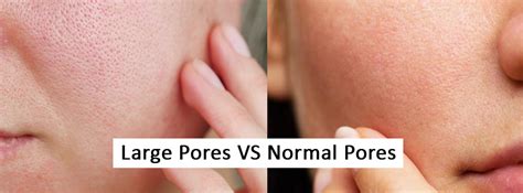 Pore Refinement 101 How To Minimize Enlarged Pores Silken Cosmetics Pte Ltd