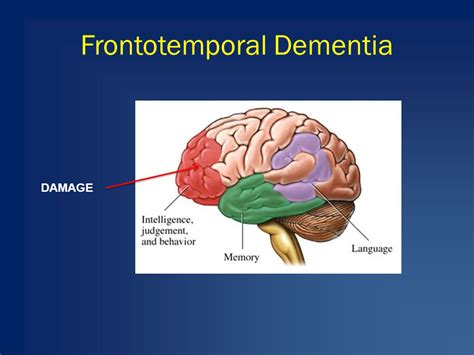 Frontotemporal Dementia What Are The Symptoms Illinois Cognitive