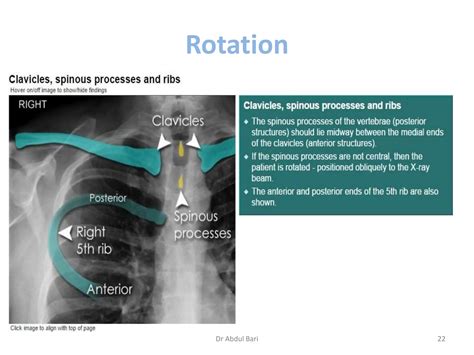 Chest X Ray Teaching Tutorial Pptx