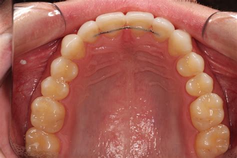 Aligner Treatment Clinical Cases Acura Aligner Solutions