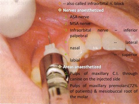 Maxillary Nerve Blocks Ppt