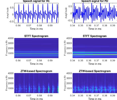 figure 1 from automatic detection of parkinson s disease using zero