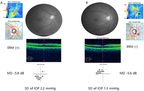 A A Female Ages 5060 Years Old Had Glaucoma And Epiretinal Membrane