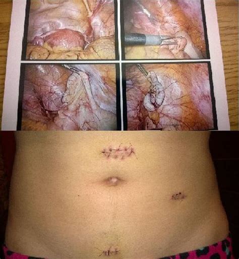 On March 10th I Had An Appendectomy Had My Appendix Romoved For Those