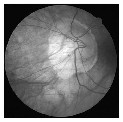 Two Segmentation Results Of Ill Conditioned Retinal Images The Download Scientific Diagram