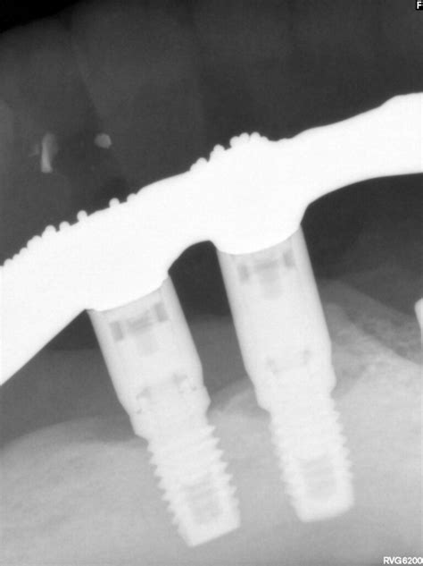 Management Of A Dislodged Implant Supported Full Arch Bridge Due To