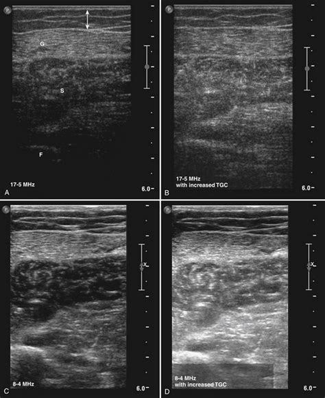 Ultrasound Of Muscle Radiology Key