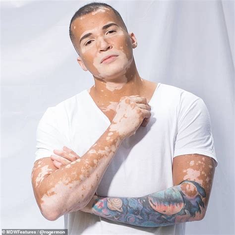 Model 37 With Rare Skin Condition Vitiligo Says Strangers Thought